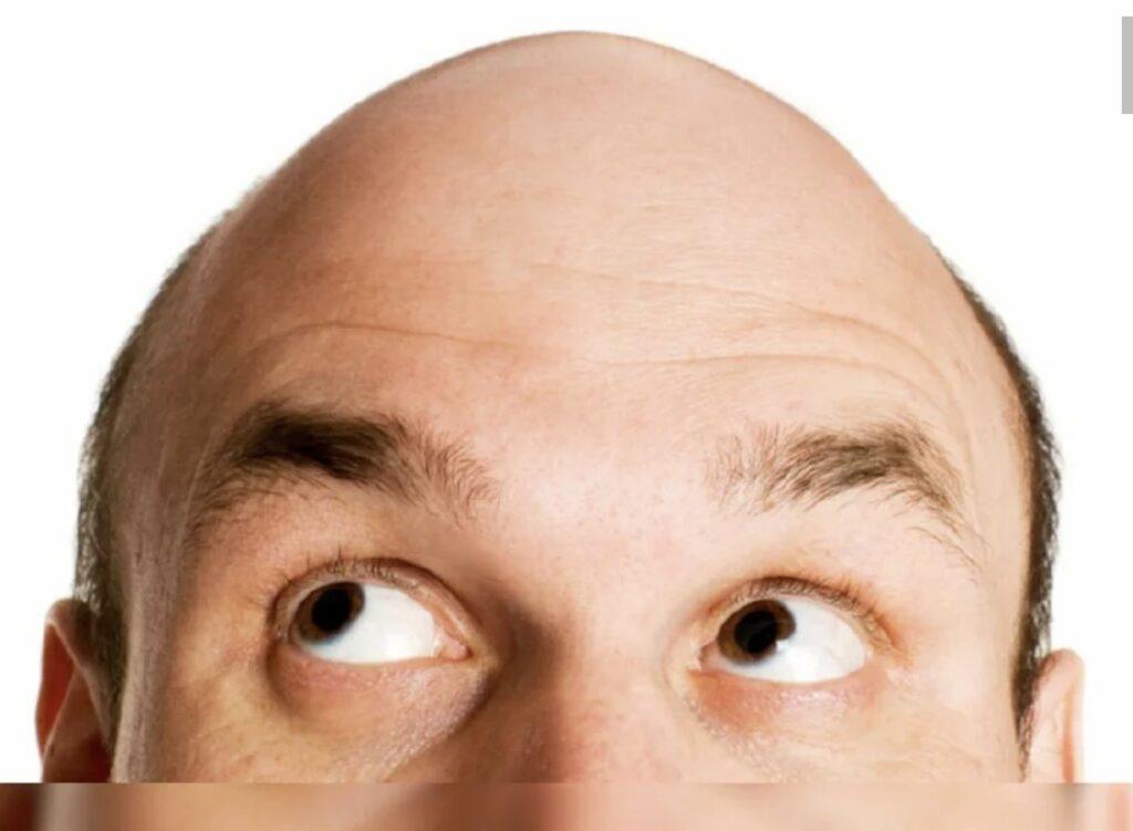 Teh, kopi dan minuman bertenaga punca botak - MYKMU.NET